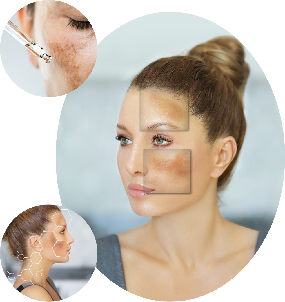 The Best Way to Treat Hyperpigmentation with SkinCues Trio Serum Set